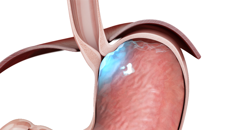 Gastroesophageal Reflux - Coulee Medical Center